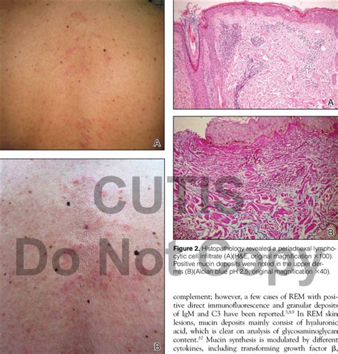 Reticular Macular Erythema And Erythematous Plaques On The Midline Of Download Scientific