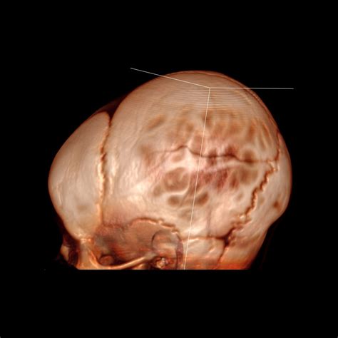 Infant With Left Parietal Soft Tissue Swelling Pediatric Radiology