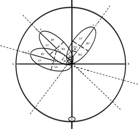 Schematics Image Of Three Types Of Cardiac Axis Left Deviation Of The