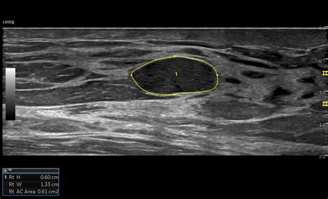 Logiq™ P9 Xdclear™ Ultrasound System Ge Healthcare