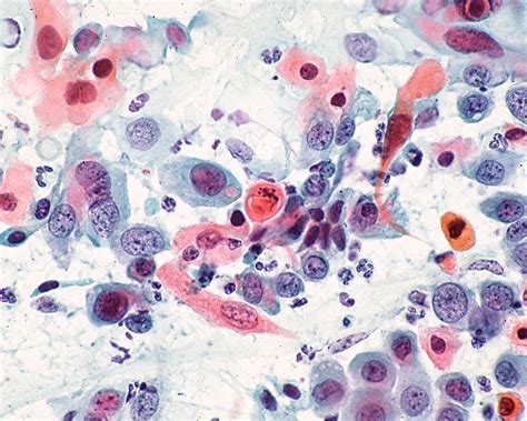 Squamous Cell Carcinoma University Of Wisconsinmadison