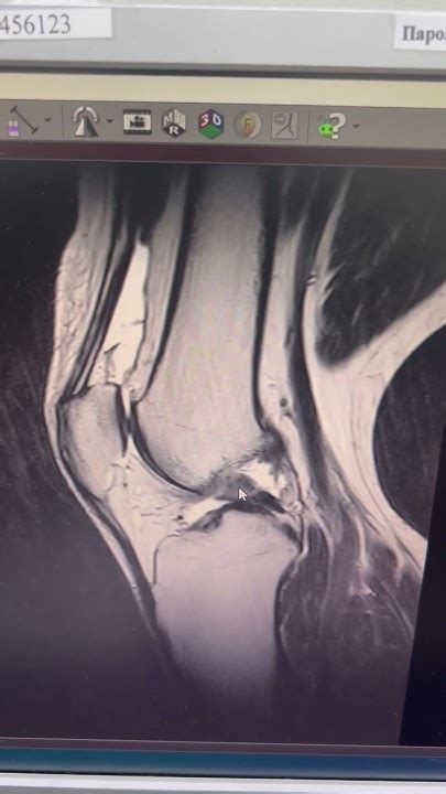 Видео МРТ где отсутствует передняя крестообразная связка и поврежден мениск массаж доктор