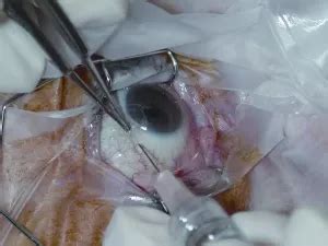 Intravitreal Injection American Academy Of Ophthalmology