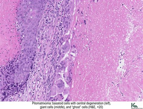 Pathology Outlines Pilomatrixoma