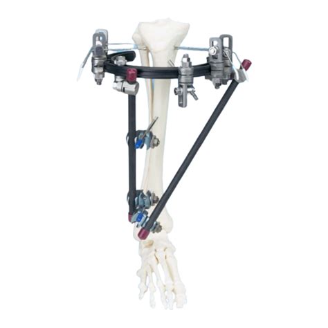 Synthes Hybrid Fixator Proximal Tibia Frame Technique Manual Pdf
