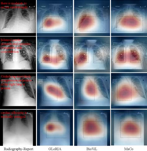 Enhancing Representation In Radiography Reports Foundation Model A Granular Alignment Algorithm