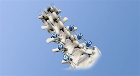 Compatibility Between Zimvie Vital Fixation And Brainlab Navigation