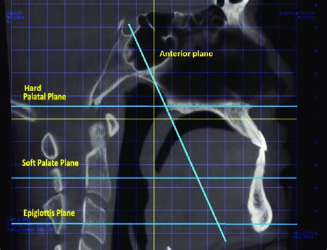 Four Planes Used Anterior Plane Hard Palatal Plane Soft Palate Download Scientific Diagram