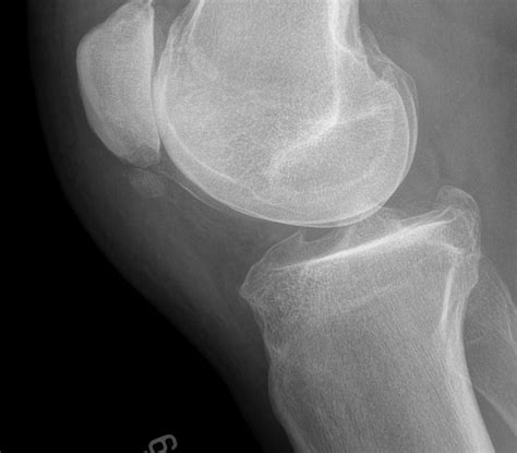 Quadriceps Tendon Calcification
