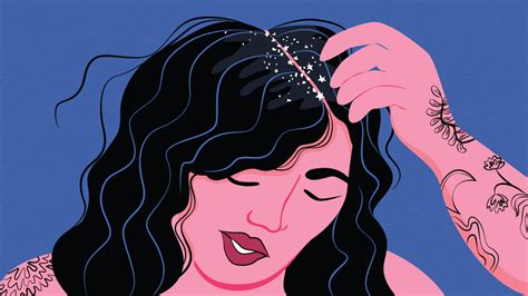 Почему появляется перхоть 6 главных причин Как избавиться от перхоти рассказывает врач