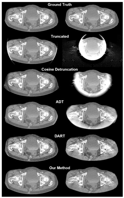 Detruncation Of Clinical Ct Scans Using A Discrete Algebraic Reconstruction Technique Prior