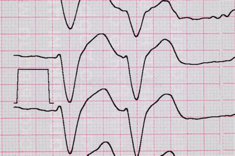 Ecg With Rhythm Disturbance Ventricular Extrasystole Close Up Premature Contraction Of The