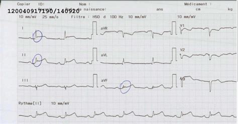 Figure 1 From Retrograde Cto Pci Using An Internal Thoracic Bypass Graft Segment In A Patient