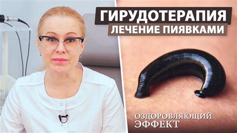 Пиявки - фото, способы применения, лечебное воздействие, показания и ...