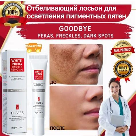 Крем для отбеливания и удаления веснушек 20мл для лица против пигментации и пигментных пятен от