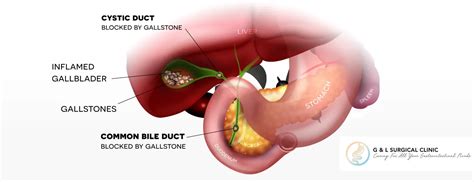What Causes Bile Duct Infection