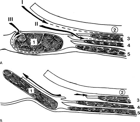 A Modification Of The “components Separation” Technique For