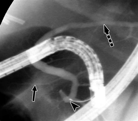Annular Pancreas X Ray