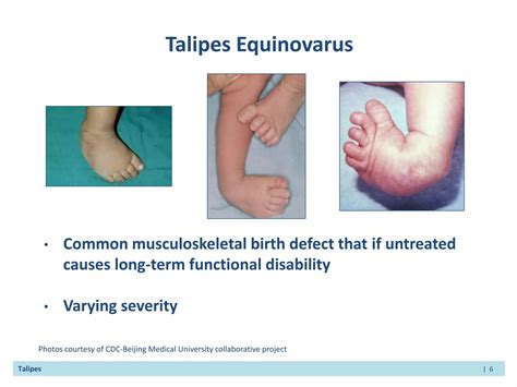 Idiopathic Talipes Equinovarus Congenital Clubfootpptx