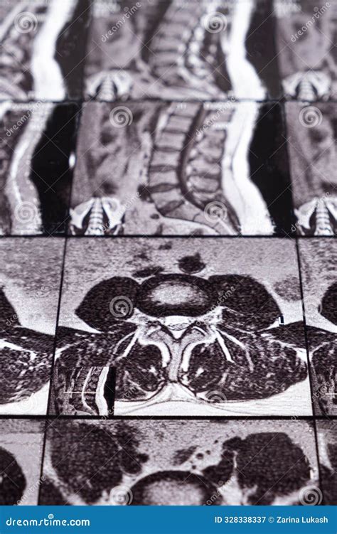 Mri Of A Patient With Intervertebral Disc Protrusion And