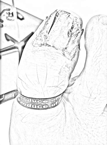 Matrixectomy Ottawa Foot Clinic