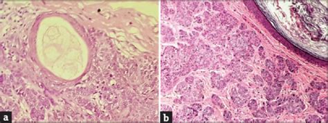 Poroid Hidradenoma Revisited Pmc