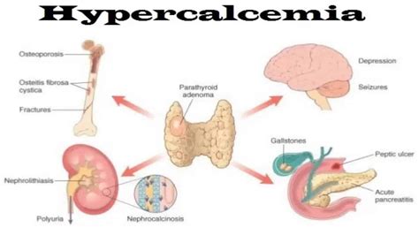 Hypercalcemia New