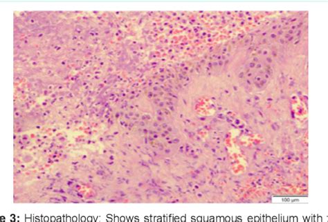 [pdf] Case Report Pyoderma Gangrenosa In Post Donor Nephrectomy Patient Semantic Scholar