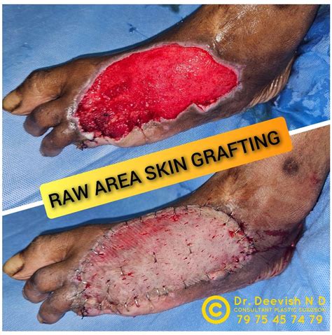 Deevish Dinakara On Linkedin Skingrafting Plasticsurgery Drdeevishnd Healiosrnr