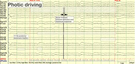 Activation Photic Stimulation