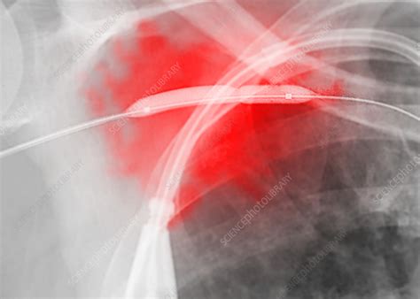 Treatment For Blocked Arteries Angiogram Stock Image F0377247