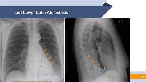 Imaging Radiographic Findings Of Lung Densities Pptx