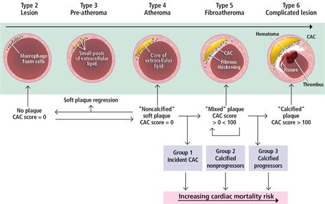 Coronary Artery Calcium Scoring Its Practicality And Clinical Utility