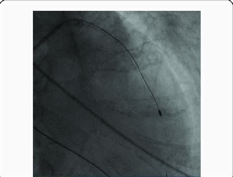 Rotablation Atherectomy Of The Lad Download Scientific Diagram