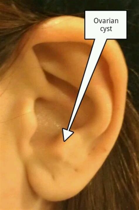Best Auricular Images On Pinterest Acupressure Acupuncture And Traditional Chinese Medicine