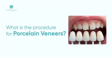 What Is The Procedure For Porcelain Veneers Smithville Dentaltx