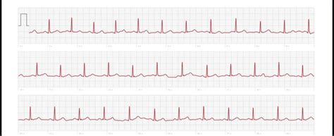 Prolonged Qtc Interval Rreadmyecg