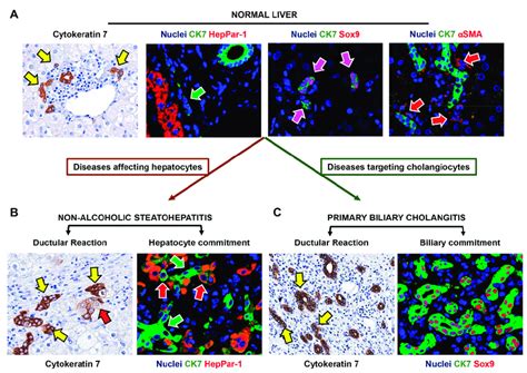 Hepatic Stem Progenitor Cell HpSC Phenotype In Normal Liver And In Download Scientific