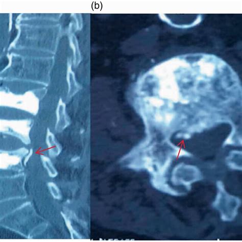 Preoperative Sagittal Reconstruction A And Axial B Computed