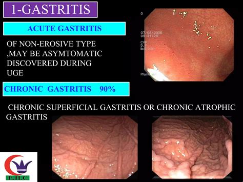 Role Of Endoscopy In Management Of H Pylori Disorders Ppt Free Download