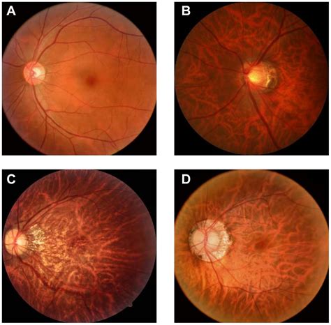 Peripapillary Atrophy Geographic Atrophy