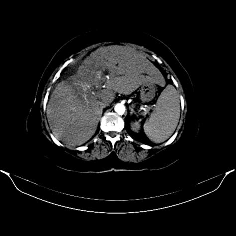 Cholangiocarcinoma Image