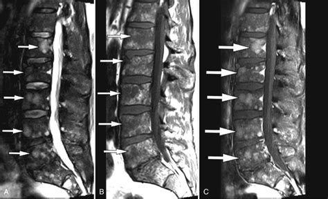 Multiple Myeloma X Ray