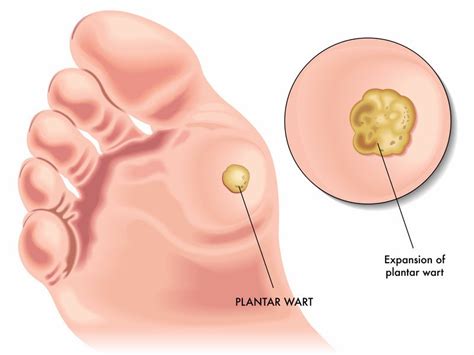 Warts Guide Causes Symptoms And Treatment Options