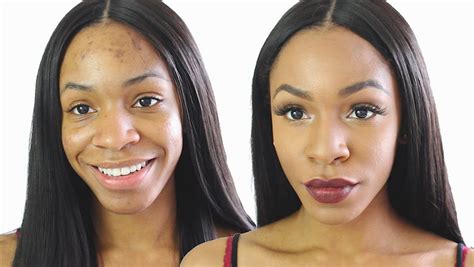 Simple Ways To Remove Scars At Home Classic Ghana