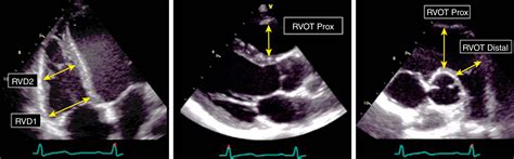 Assessment Of Right Ventricular Systolic And Diastolic Function Clinical Tree