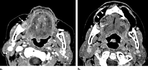 Squamous Cell Carcinoma Of The Retromolar Trigone A Axial Ct Scan
