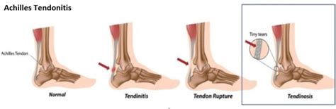 Achilles Tendinopathytendonitis Complete Physio