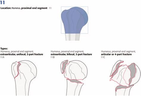 The 3 Types A B And C Of Proximal Humerus Fractures Bone Location