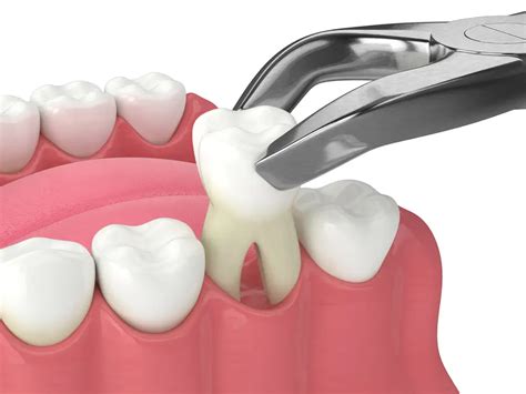Preventing Bone Loss After Tooth Extraction Alpha Dental